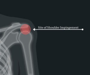 Shoulder Impingement | CMF Chiropractic
