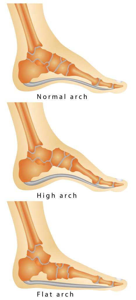 Determine Your Foot Type | CMF Chiropractic